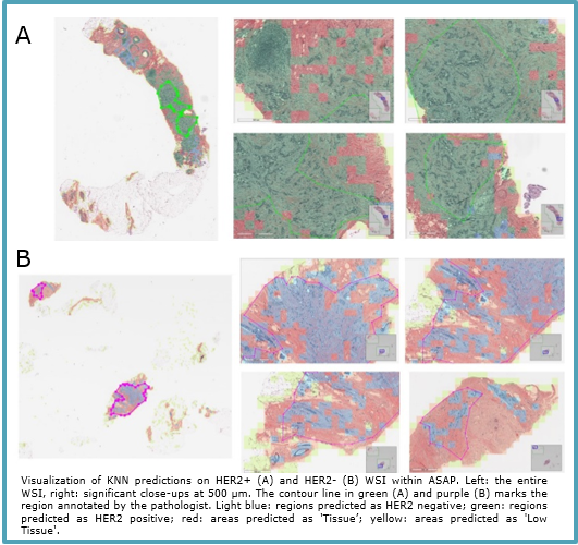 HistopathologicaI H&E-Based evaluation of HER2 status in breast cancer ...