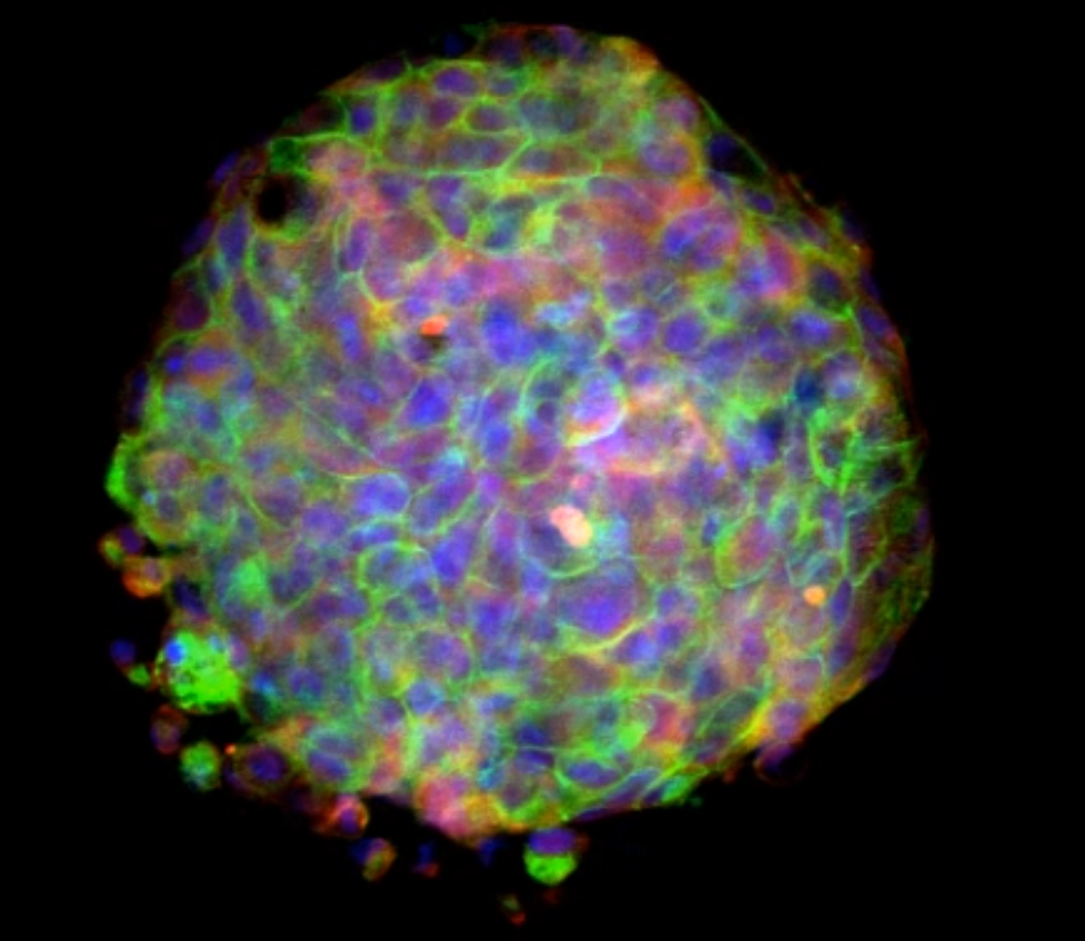 Targeting cancer-associated fibroblasts/tumor cells cross-talk inhibits ...